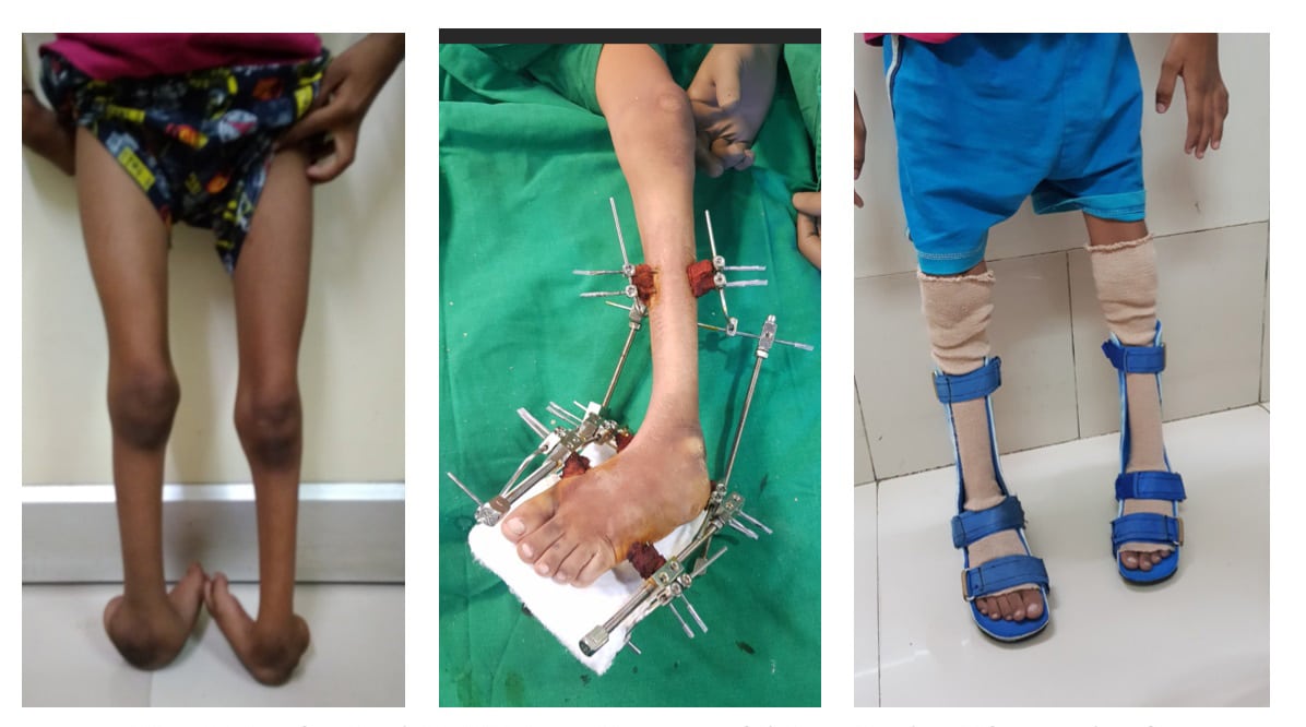 Clubfoot: What Parents Need to Know - د. عبد الحميد سيد عيسى