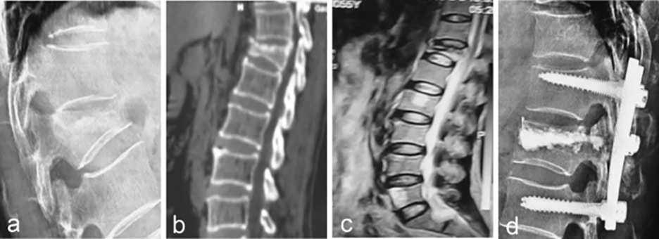 Vertebral Fixation: A Surgical Solution for Spinal Stability - د. عبد ...