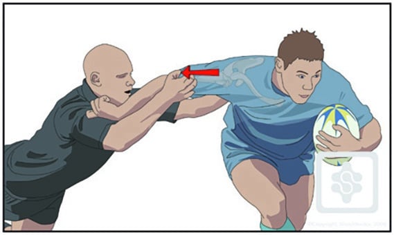 PASTA Lesion to the shoulder - د. عبد الحميد سيد عيسى