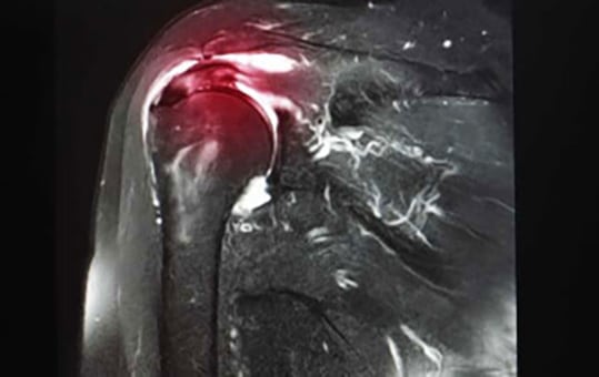 PASTA Lesion to the shoulder - د. عبد الحميد سيد عيسى